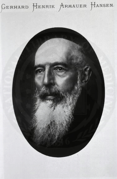 Hansen’s disease – Medical Lessons